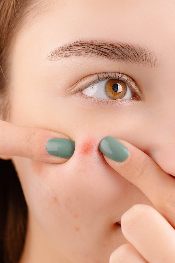 Bouton sur le visage : causes et solutions efficaces à découvrir - Gyn ...